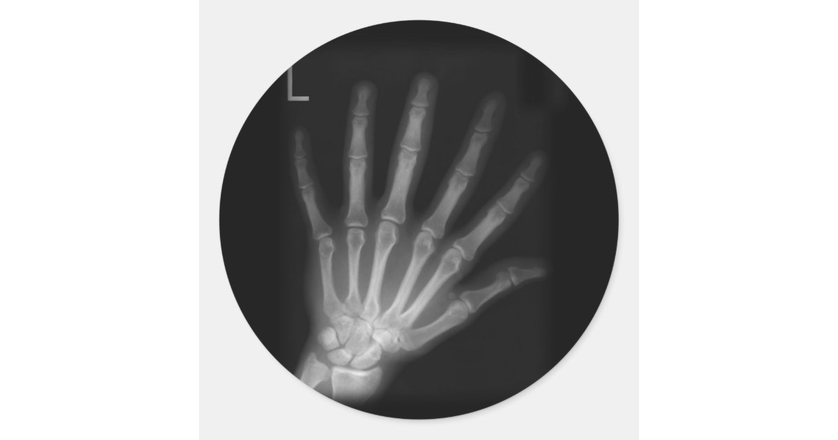 Extra cijferige röntgenfoto Linkerhand Ronde Sticker | Zazzle.nl