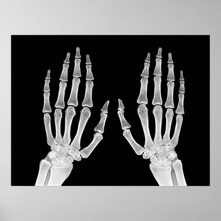 Skeleton Hands Xray Afbeelding Foto van menselijke Poster | Zazzle.nl